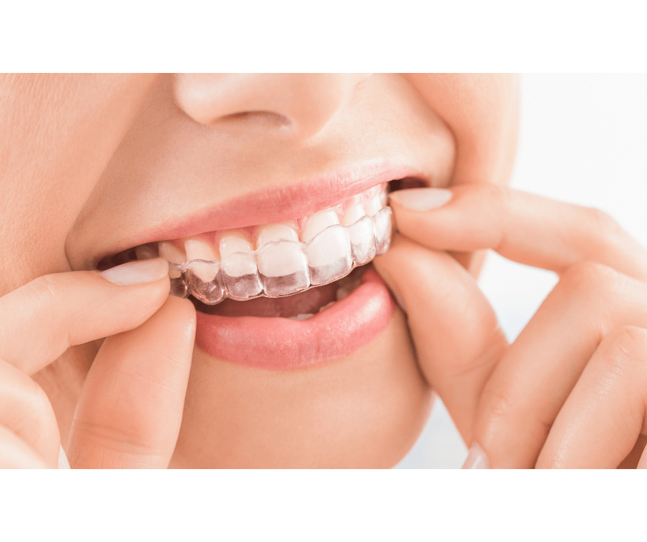 SureSmile® Orthodontics | Isaacs Family Dental